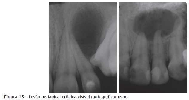 Granulomaperiapicalcasoclinico